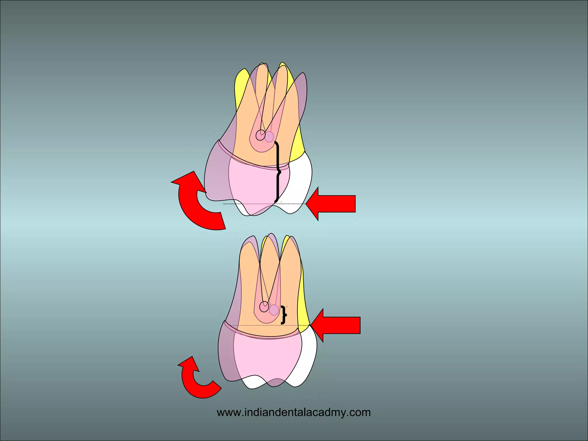 Biomechanics of molar distalisation appliance /certified fixed ...