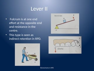 biomechanics of removable partial denture | PPTX