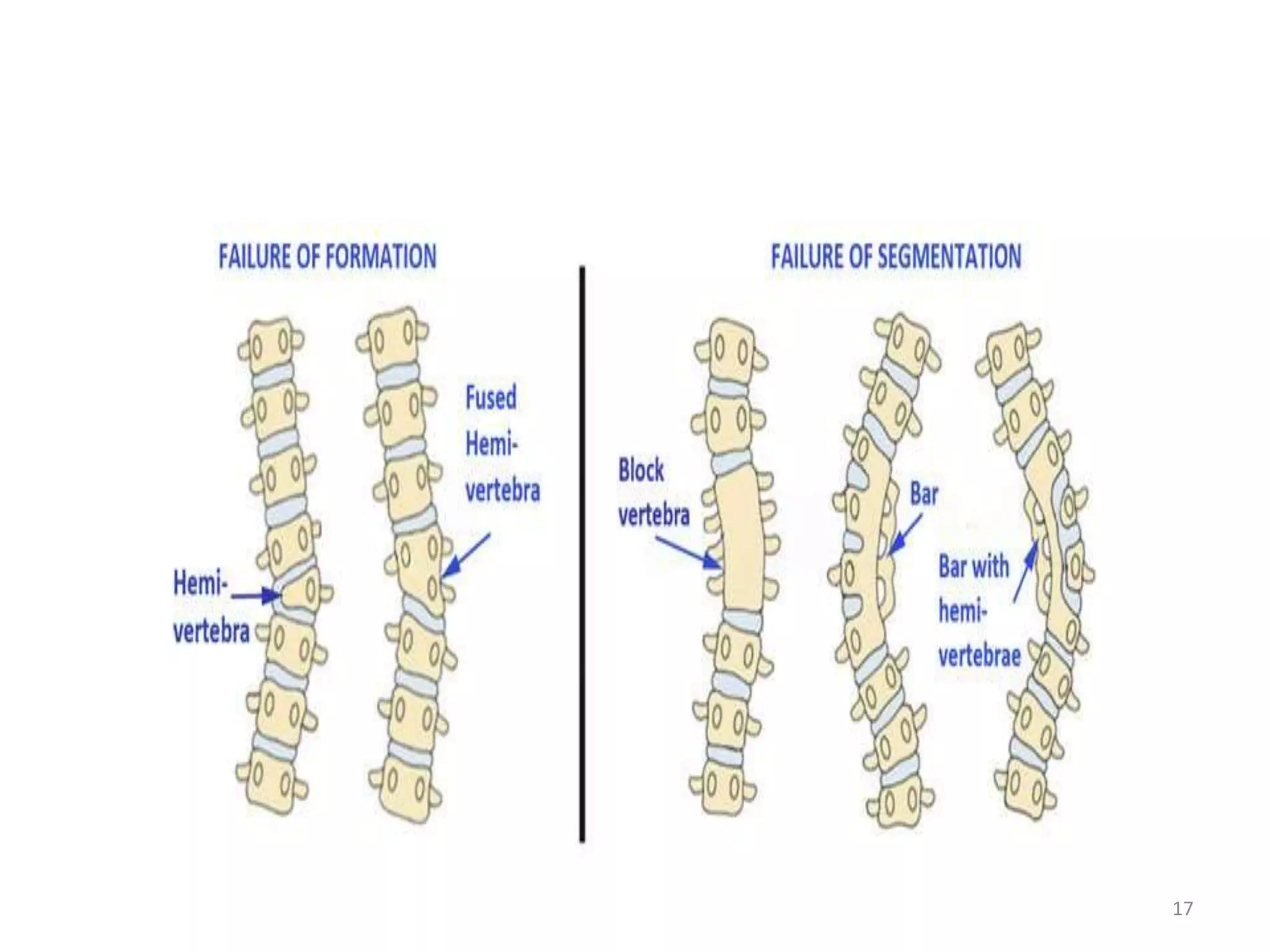 Biomechanics and pathomechanics of scoliosis | PPTX