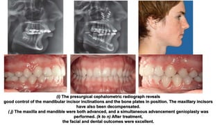 Biomechanics and treatment of skeletal deformities part 2 | PPTX