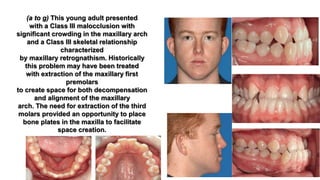 Biomechanics and treatment of skeletal deformities part 2 | PPTX