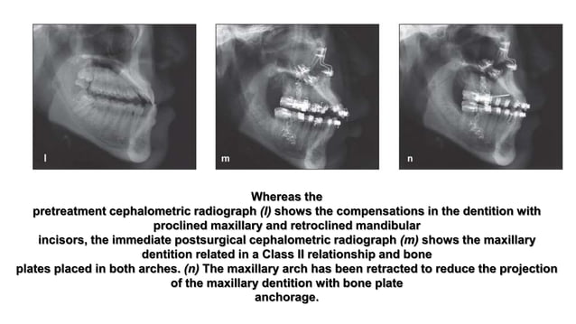 Biomechanics and treatment of skeletal deformities part 2 | PPT