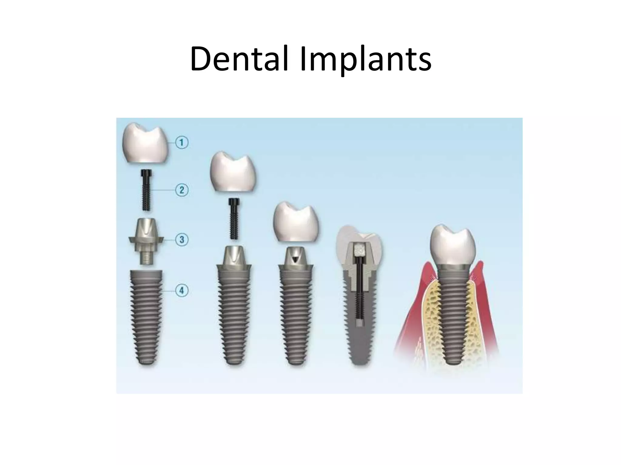 Biomechanics dental implants | PPTX