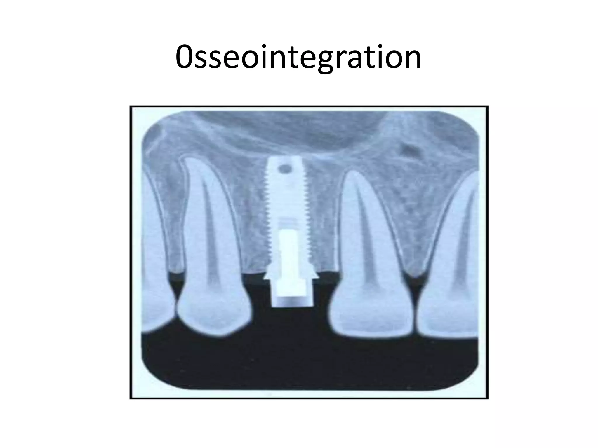 Biomechanics dental implants | PPTX