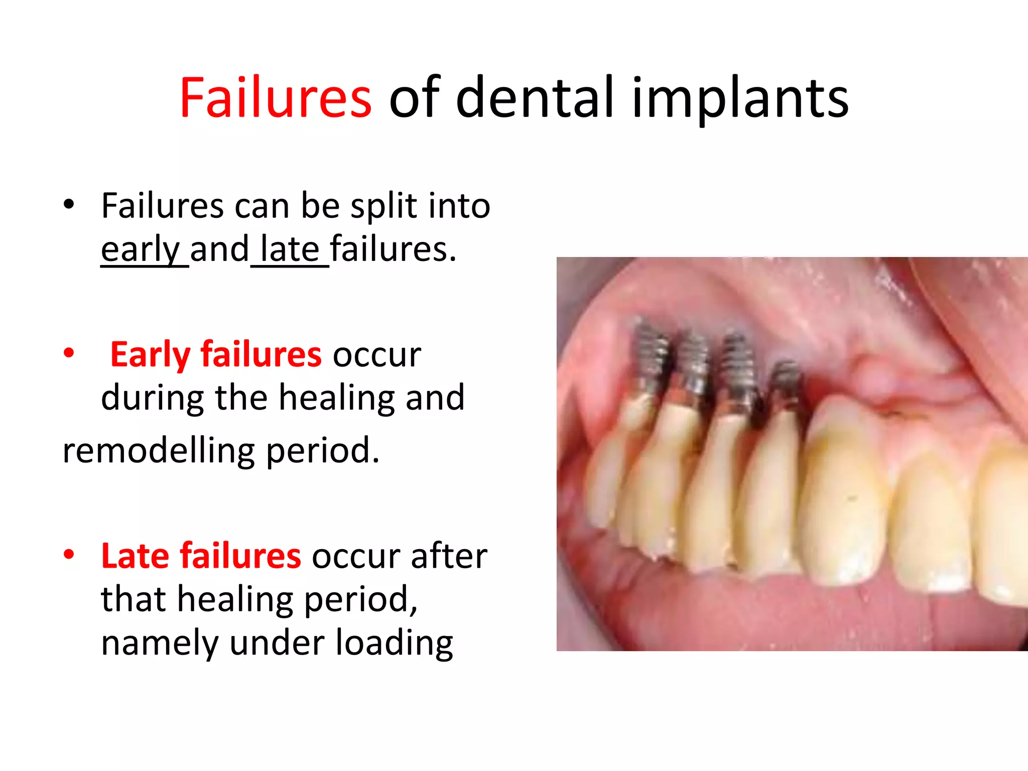 Biomechanics dental implants | PPTX
