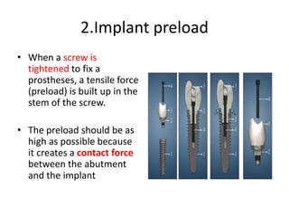 Biomechanics dental implants | PPTX