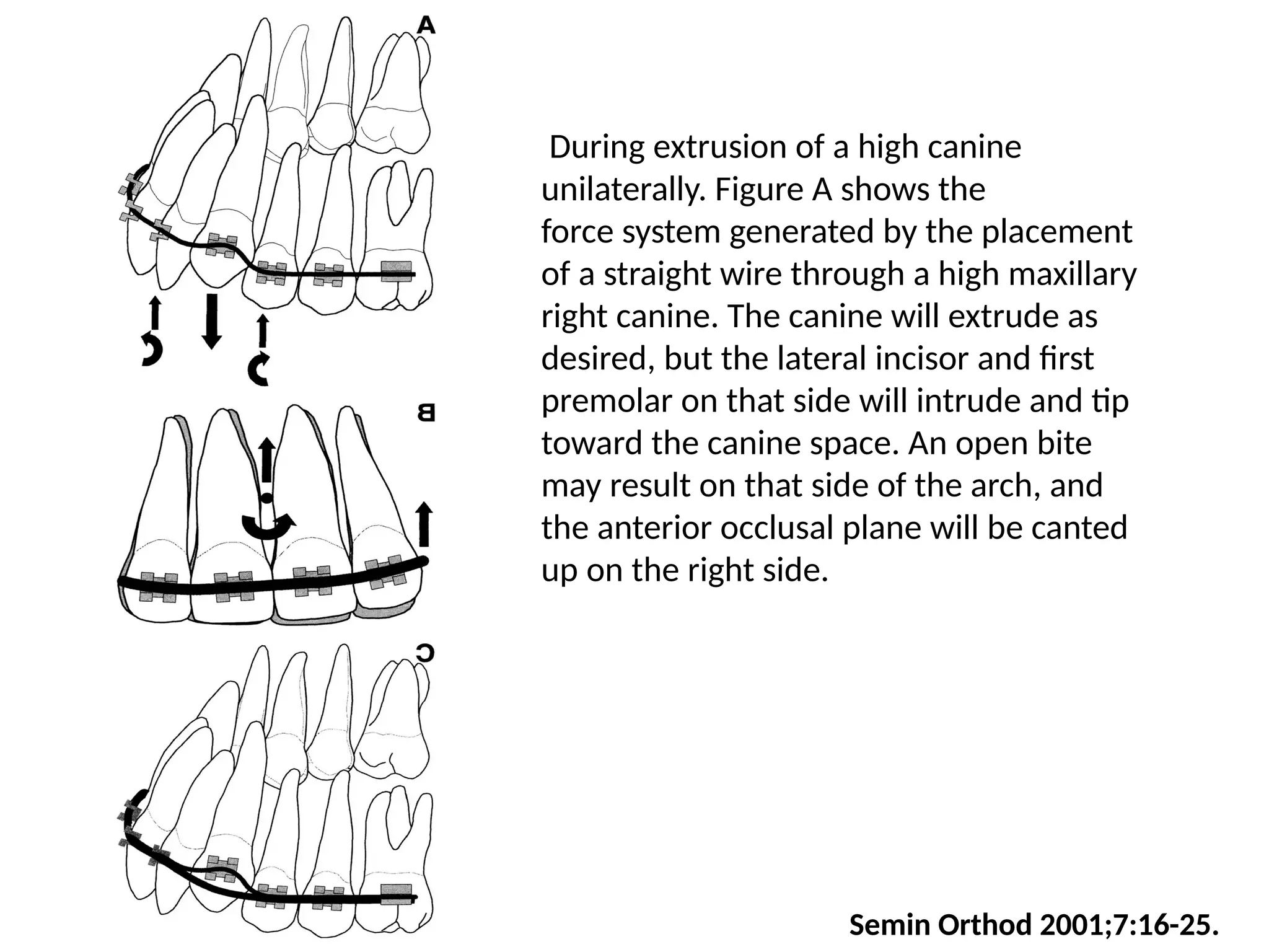 BIOMECHANICS IN ORTHONTICS , DENTISTRY.. | PPTX