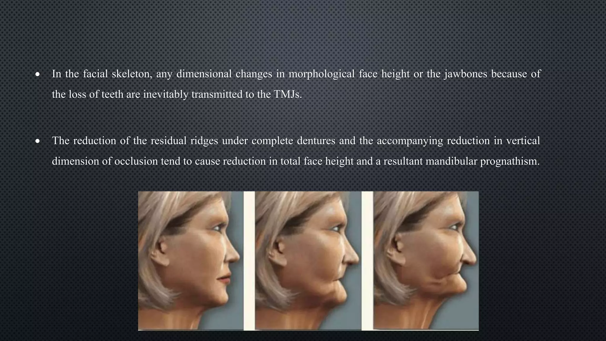 Biomechanics in edentulous state | PPTX