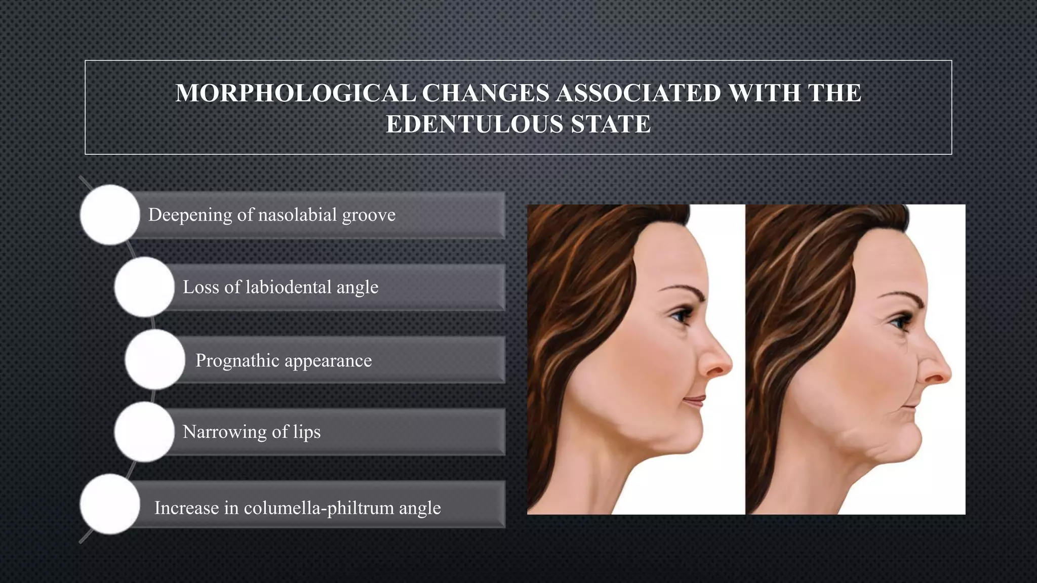Biomechanics in edentulous state | PPTX