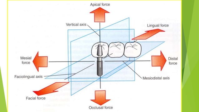 Biomechanics in implantology | PPTX | Dental Health | Diseases and ...