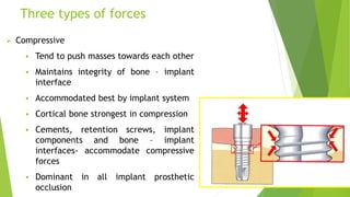 Biomechanics in implantology | PPTX