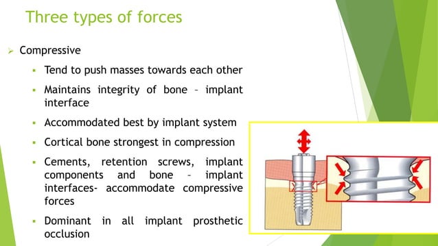 Biomechanics in implantology | PPTX | Dental Health | Diseases and ...