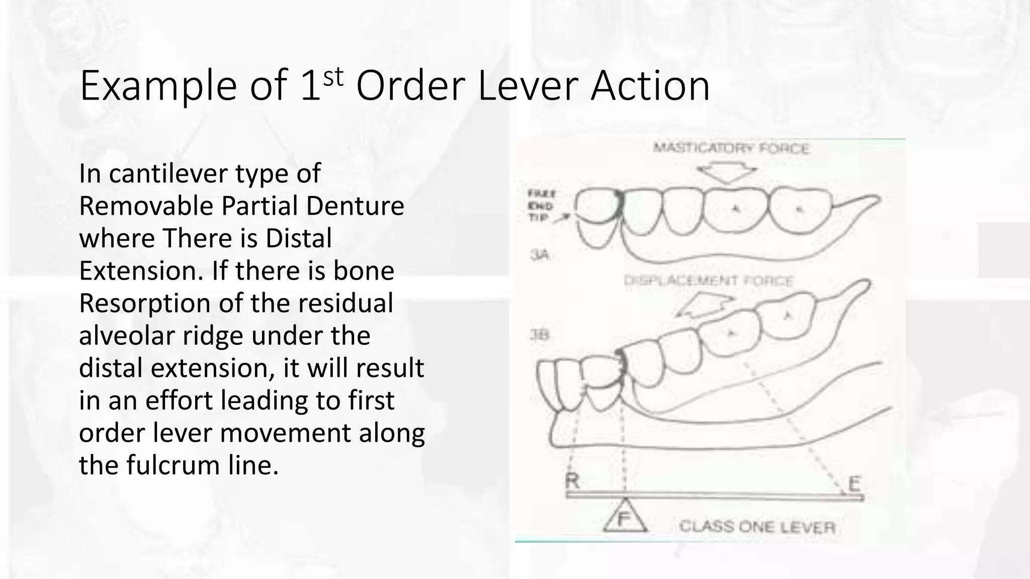 Biomechanics in removable partial denture | PPTX