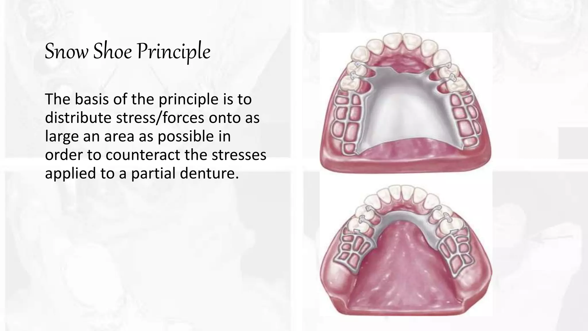 Biomechanics in removable partial denture | PPTX