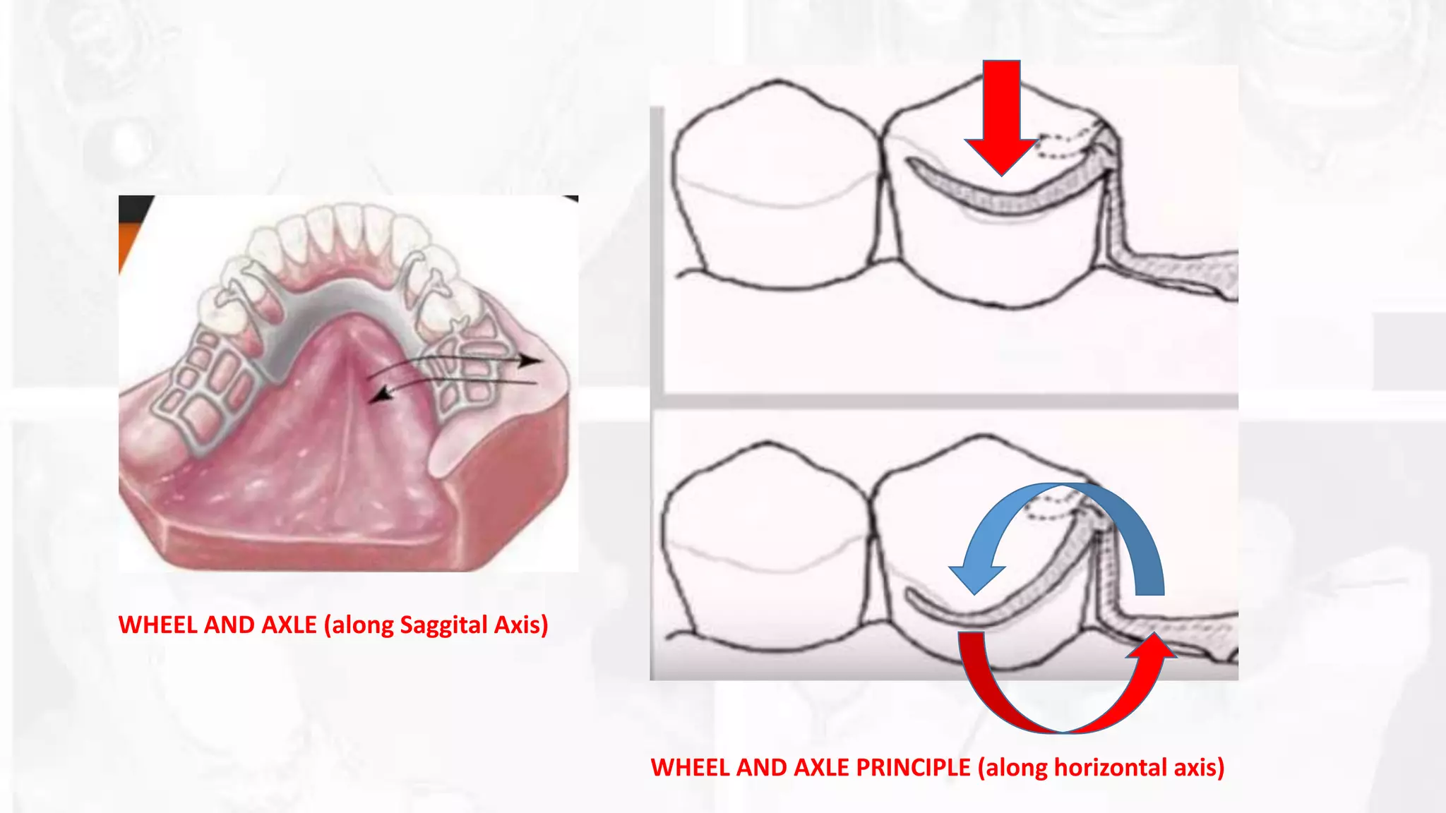 Biomechanics in removable partial denture | PPTX