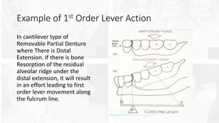 Biomechanics in removable partial denture | PPTX