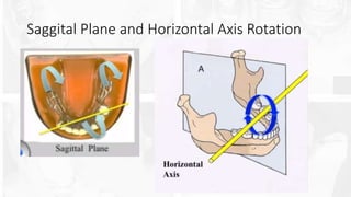 Biomechanics in removable partial denture | PPTX