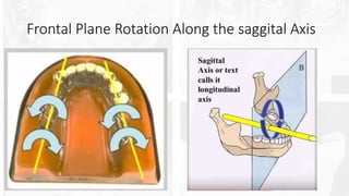 Biomechanics in removable partial denture | PPTX