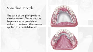 Biomechanics in removable partial denture | PPT