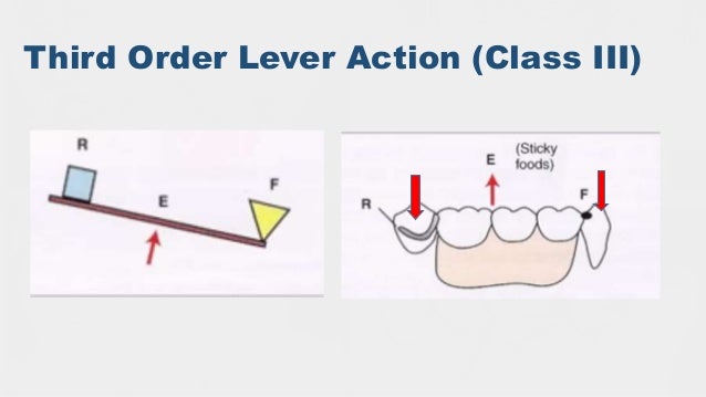 Biomechanics in removable partial denture