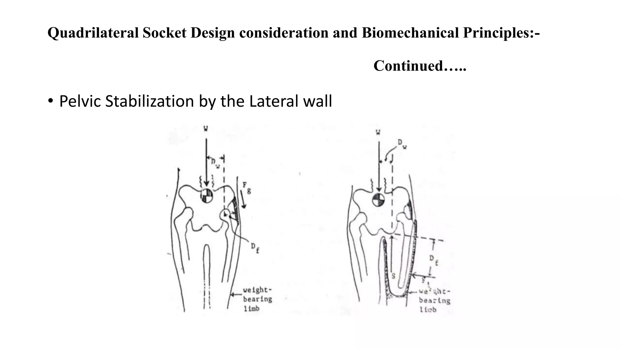 Biomechanics of Quadrilateral Socket | PPTX