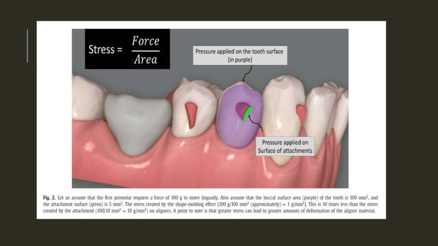 Biomechanics of clear aligners | PPTX
