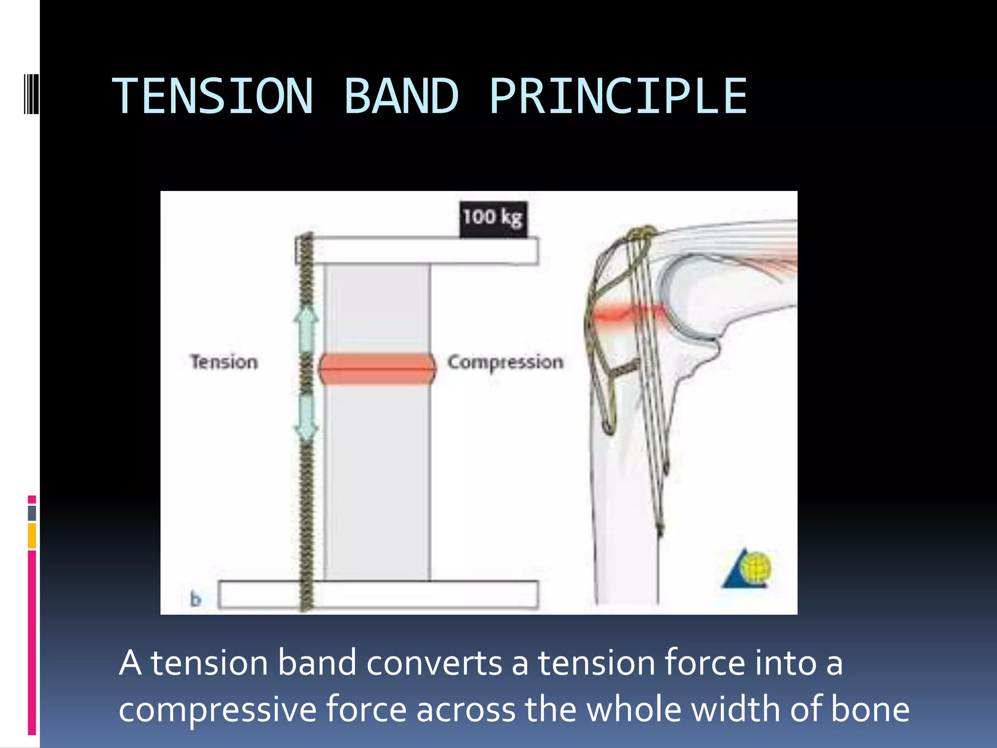 Biomechanics of common implants | PPTX