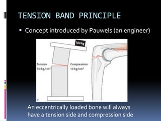 Biomechanics of common implants | PPTX