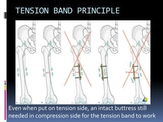 Biomechanics of common implants | PPTX