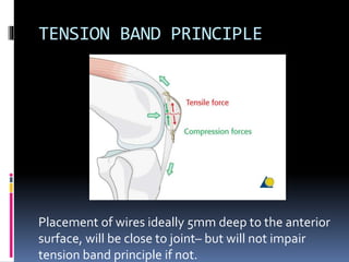 Biomechanics of common implants | PPTX