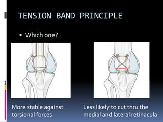 Biomechanics of common implants | PPTX