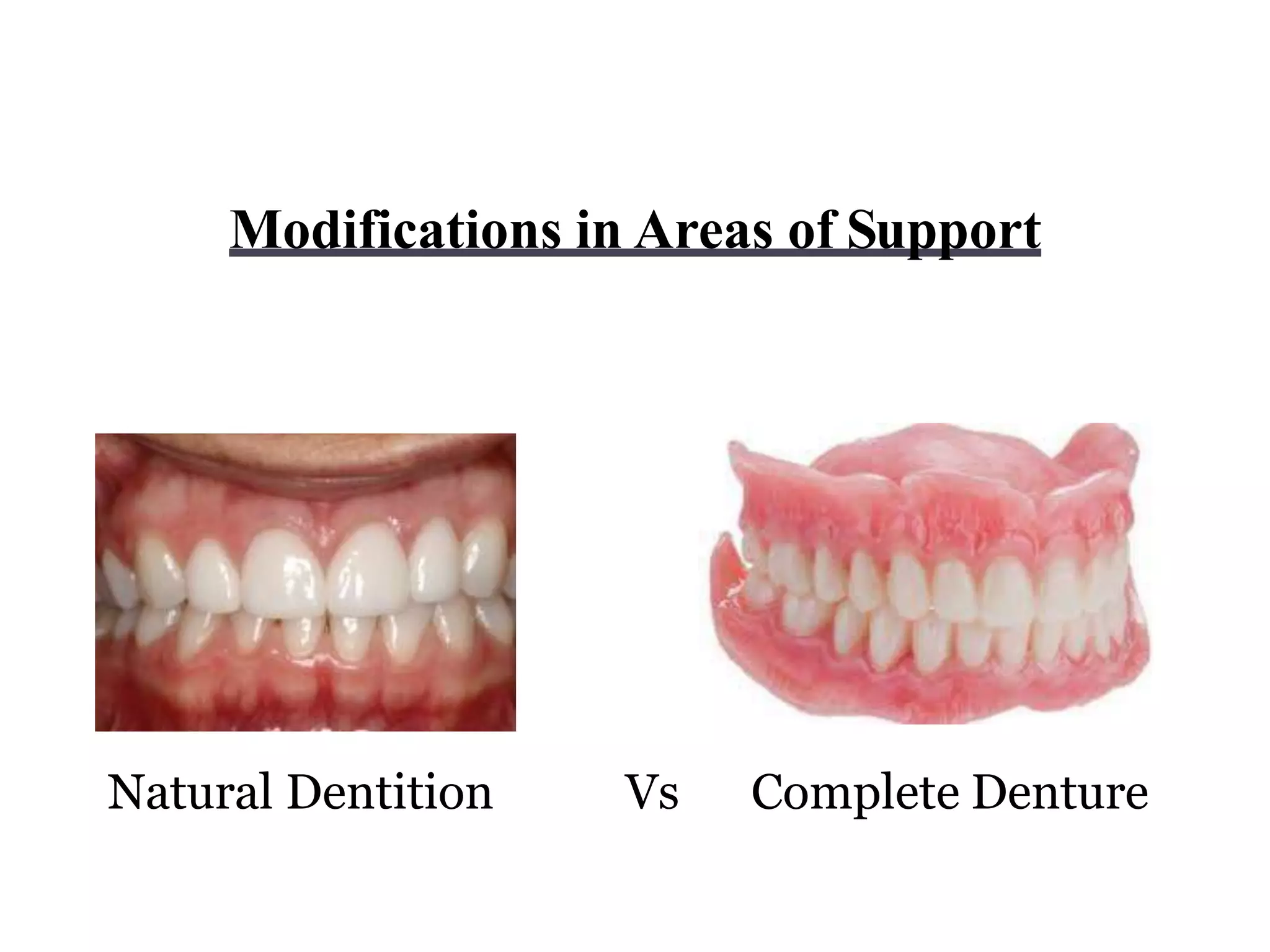 Biomechanics of Edentulous State | PPTX