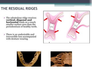biomechanicsofedentulousstate-200719071419 (1).pptx
