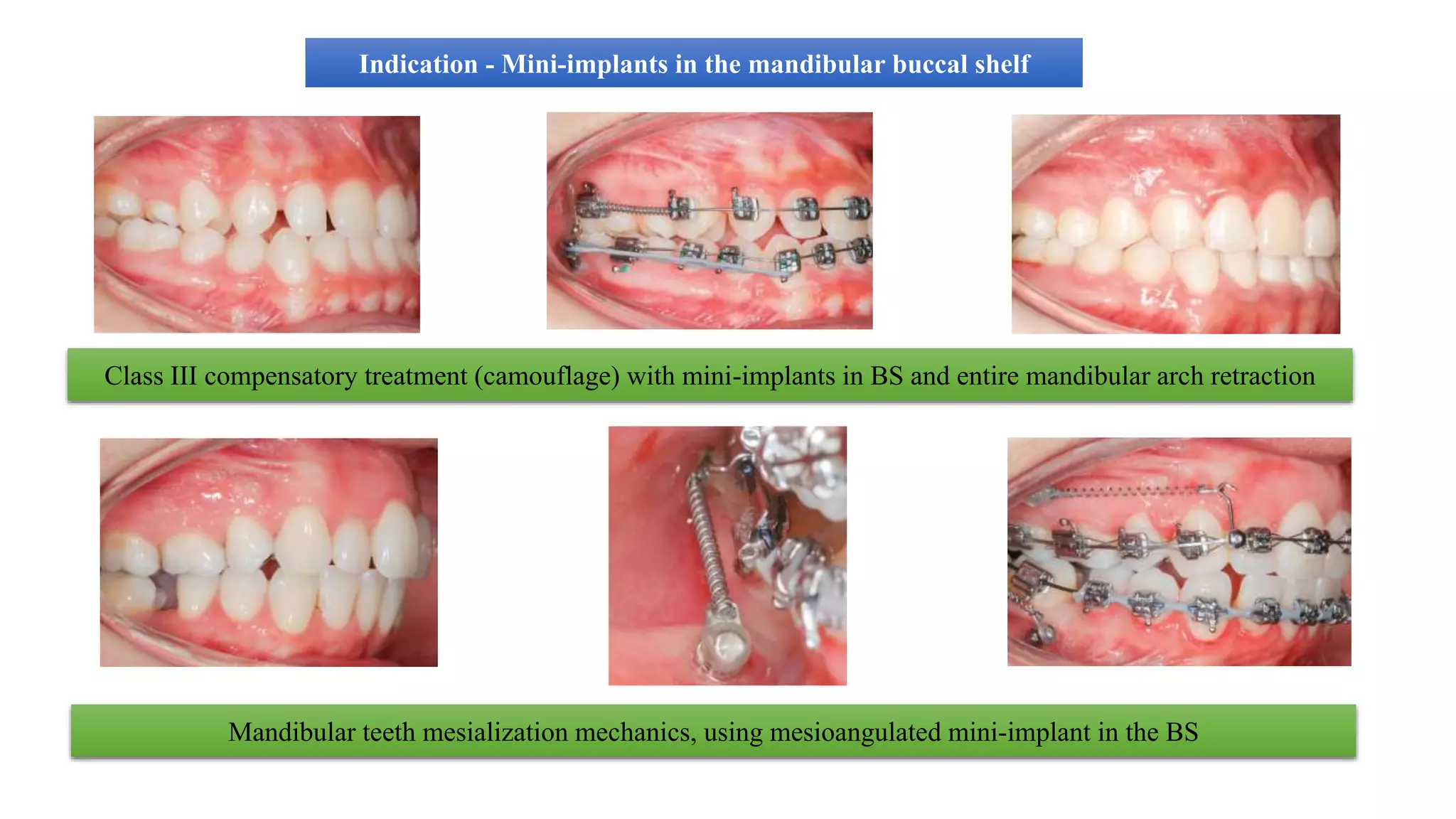 Biomechanics of extra alveolar mini-implants | PPTX