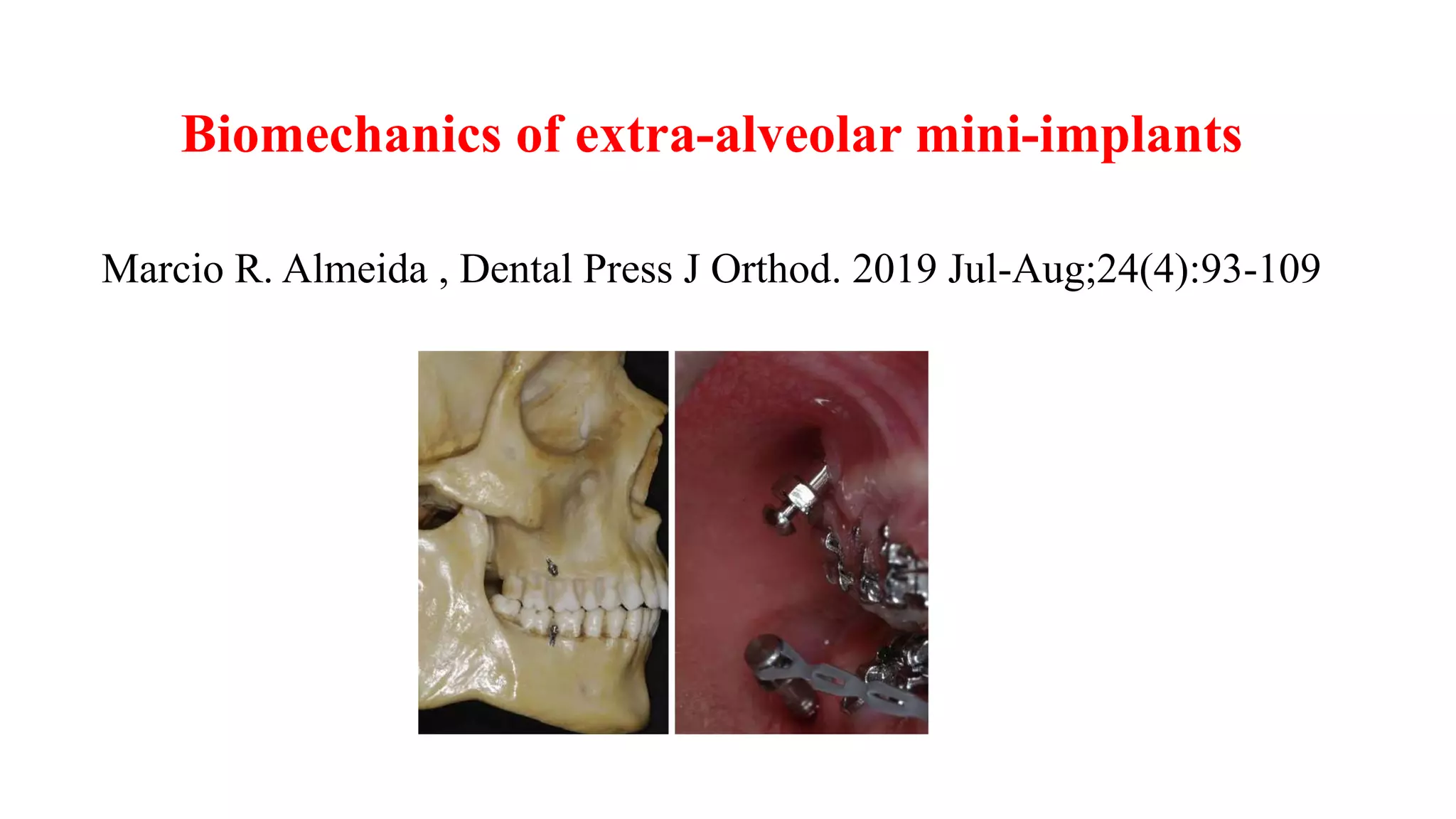 Biomechanics of extra alveolar mini-implants | PPTX