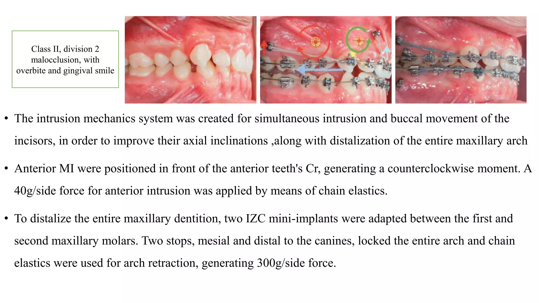 Biomechanics of extra alveolar mini-implants | PPTX