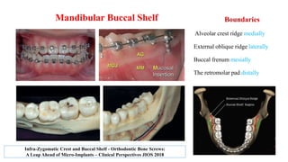Biomechanics of extra alveolar mini-implants | PPTX