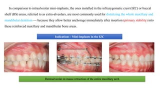 Biomechanics of extra alveolar mini-implants | PPTX