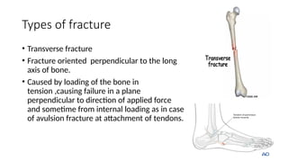 Comprehensive Biomechanics of Fracture: Bone Properties, Forces, and ...