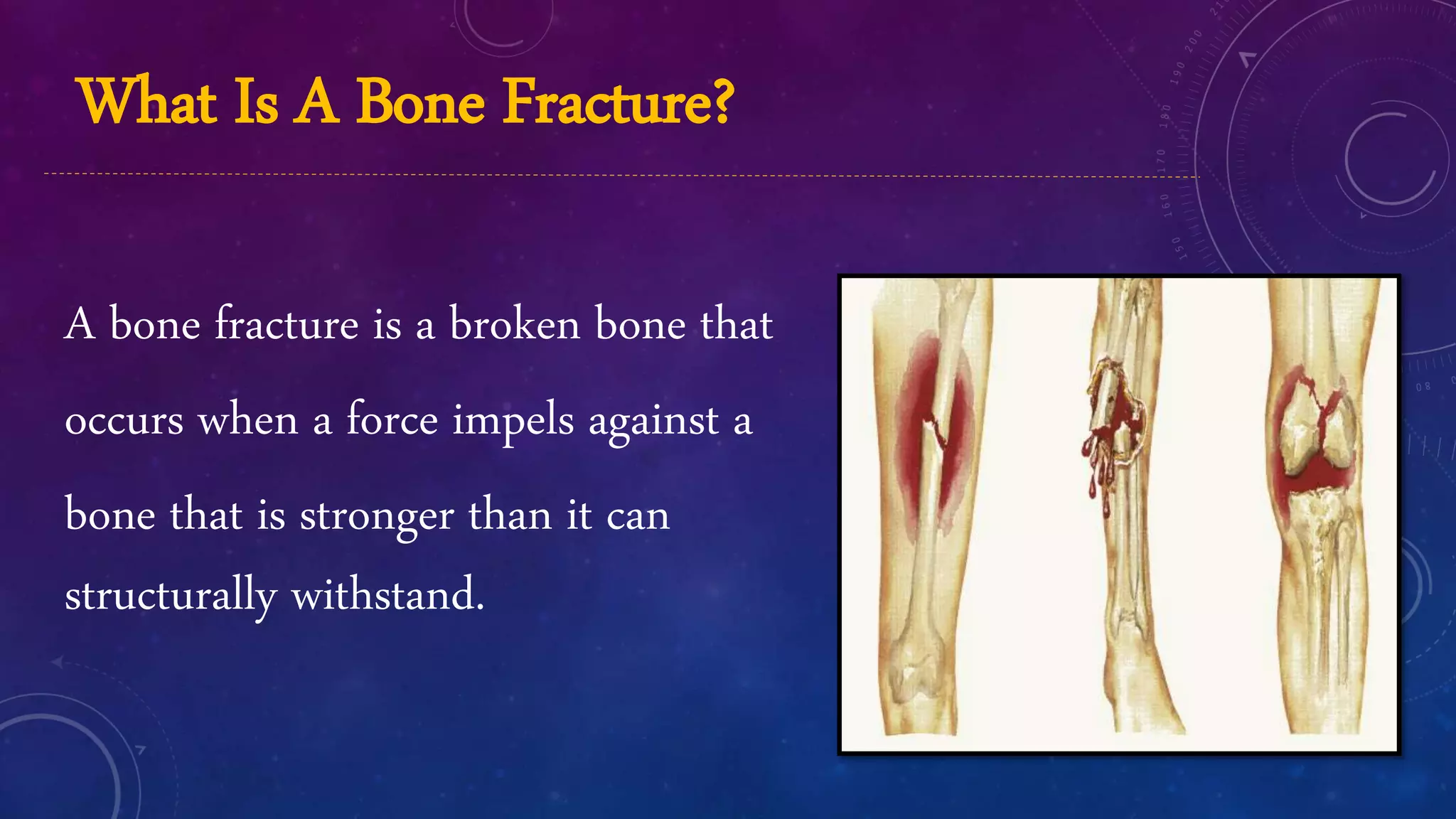 Biomechanics of fracture and fracture healing | PPTX