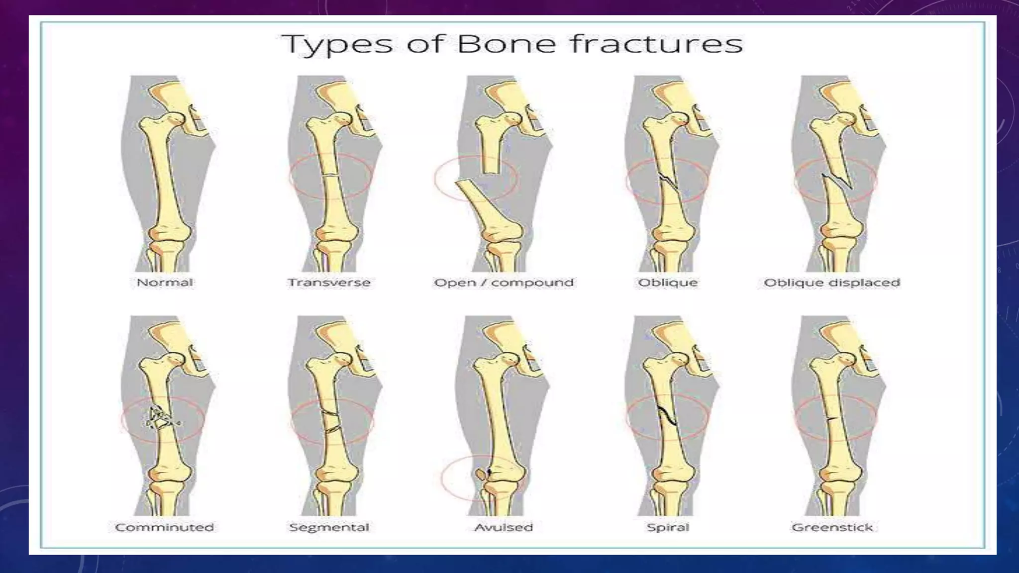 Biomechanics of fracture and fracture healing | PPTX
