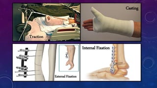 Biomechanics of fracture and fracture healing | PPTX