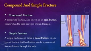 Biomechanics of fracture and fracture healing | PPTX