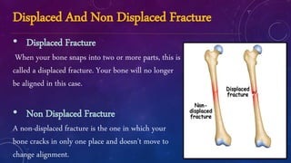Biomechanics of fracture and fracture healing | PPTX