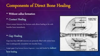 Biomechanics of fracture and fracture healing | PPTX