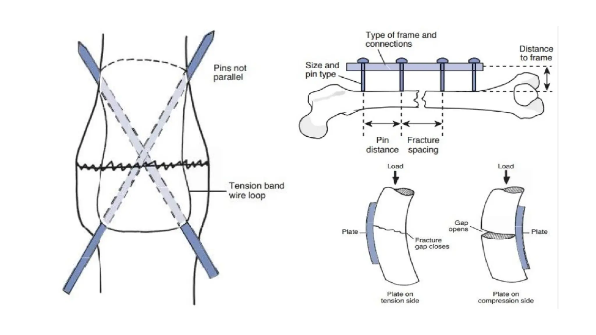 Biomechanics of fracture fixation.pptx