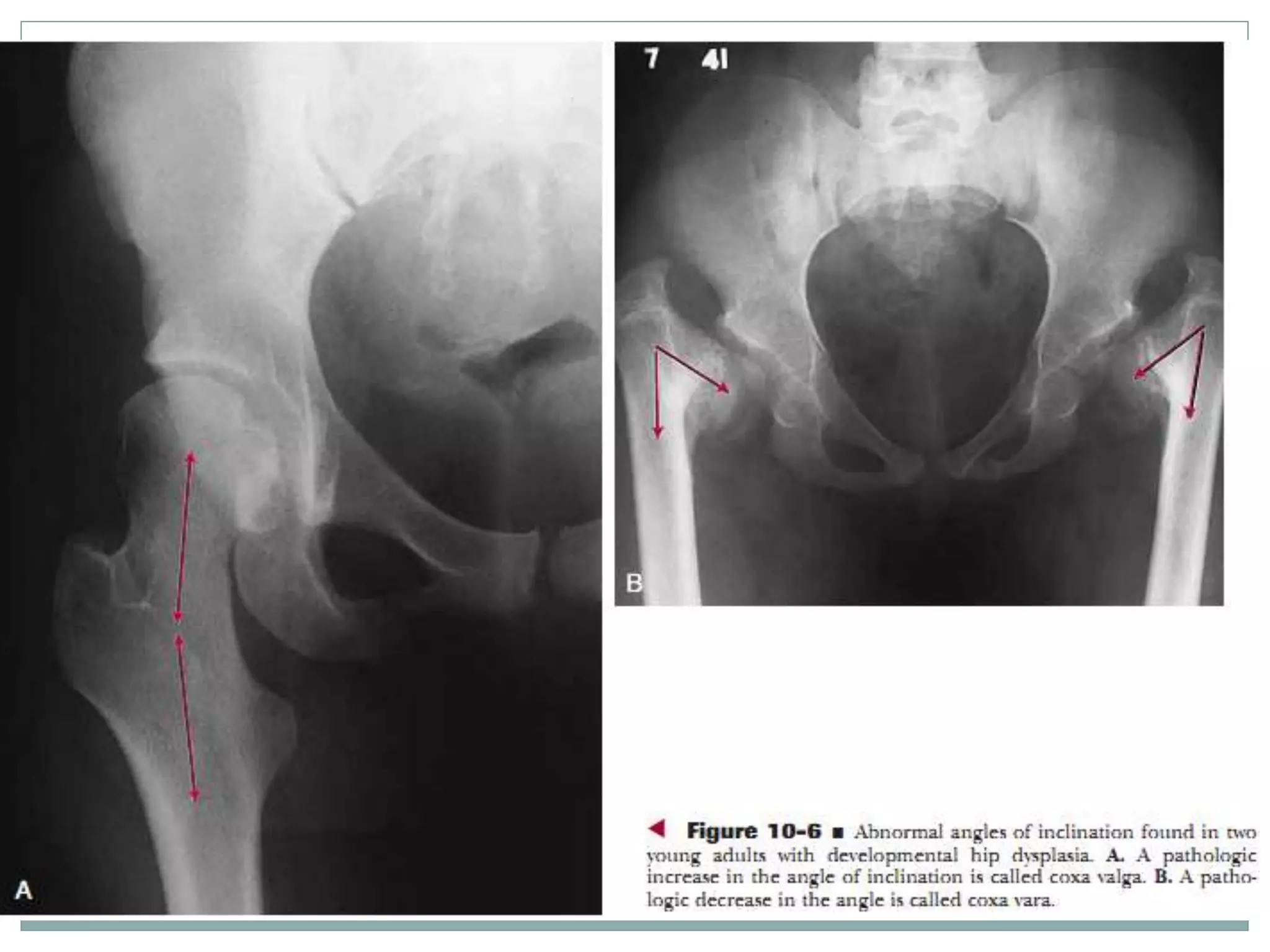 Biomechanics of hip complex 1 | PPTX