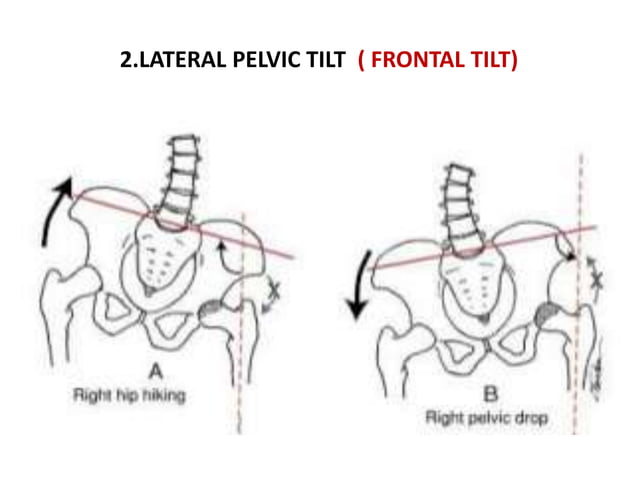 BIOMECHANICS OF HIP JOINT | PPTX | Bone and Joint Conditions | Diseases ...