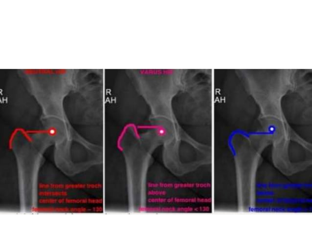 BIOMECHANICS OF HIP JOINT | PPTX | Bone and Joint Conditions | Diseases ...
