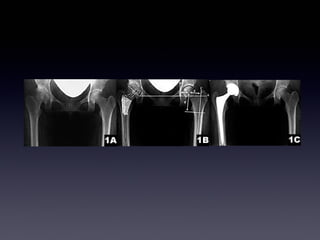 BIOMECHANICS OF HIP & TOTAL HIP ARTHROPLASTY dr samir gupta.ppt